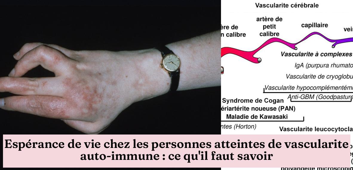Espérance de vie chez les personnes atteintes de vascularite auto ...